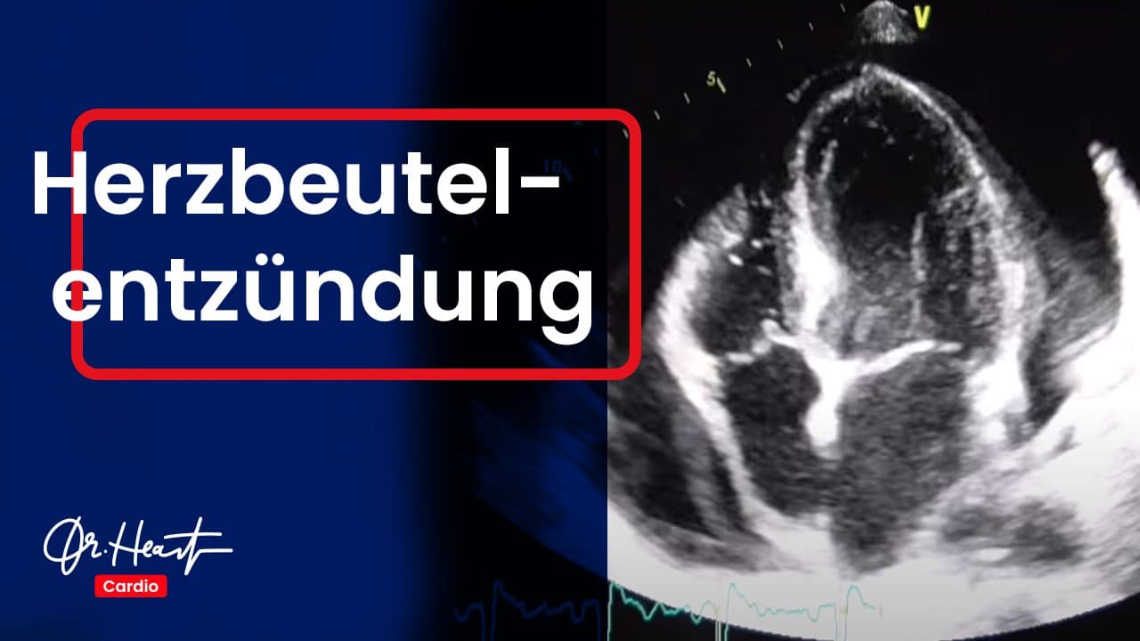 Perikarditis - Verlauf und Behandlung – Dr. Heart
